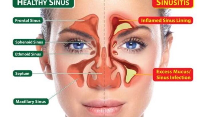 Acute sinusitis – Alsalama Healthcare@Home